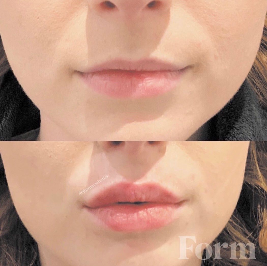 Lip Fillers Before and After and Botox - Winnipeg Fillers